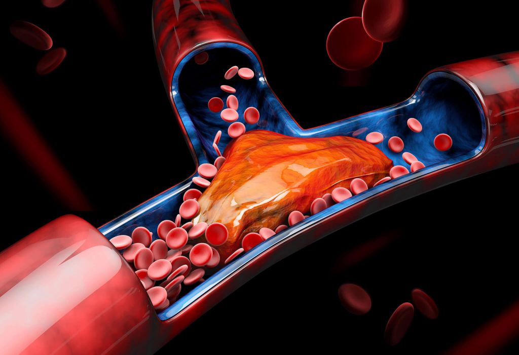 Claudicatio Intermittens - Medifit